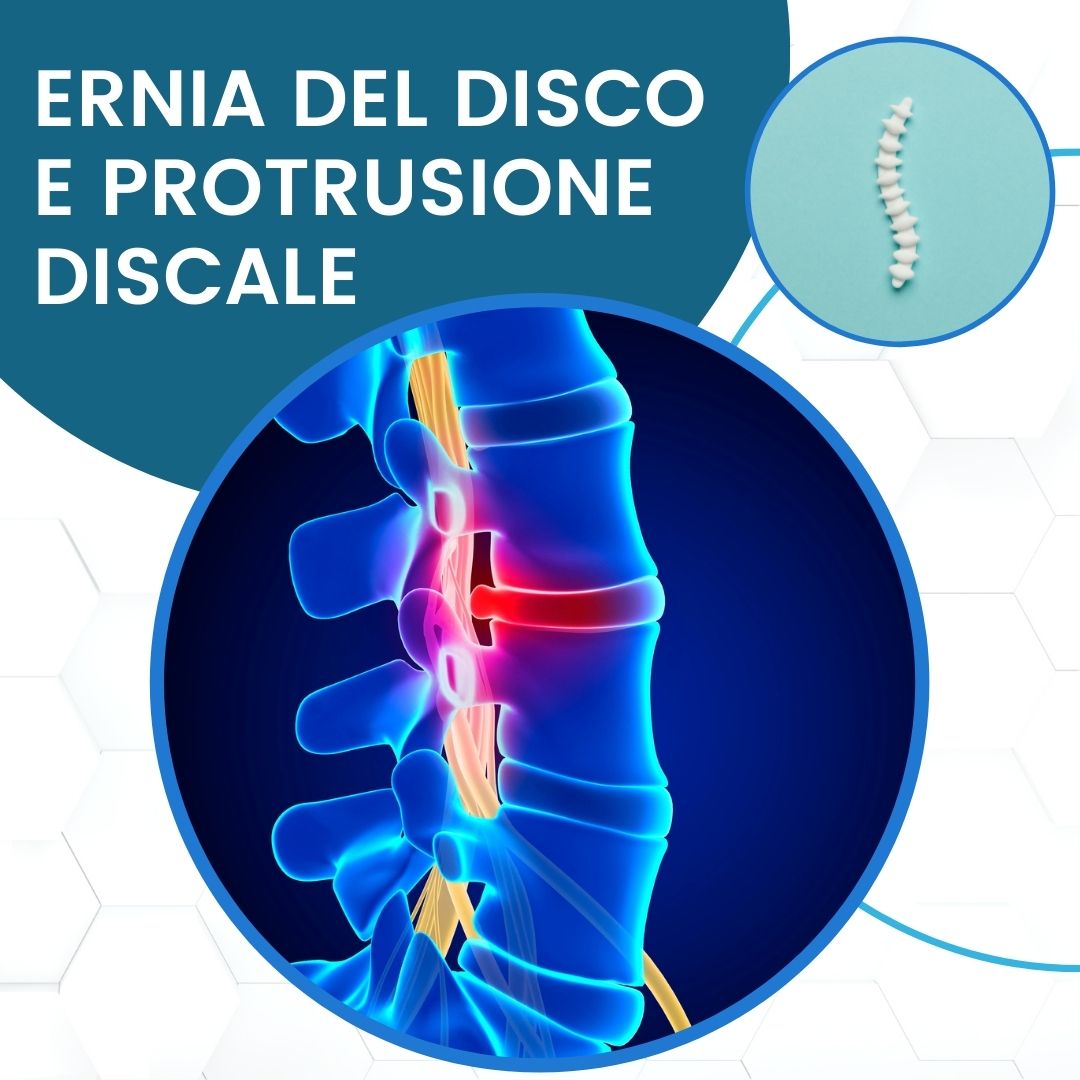 Patologie Colonna Vertebrale | Osteokinesis Osteopatia Roma