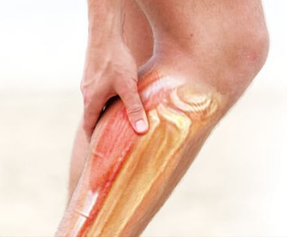 Stiramento muscolare, crampi, contratture e strappi