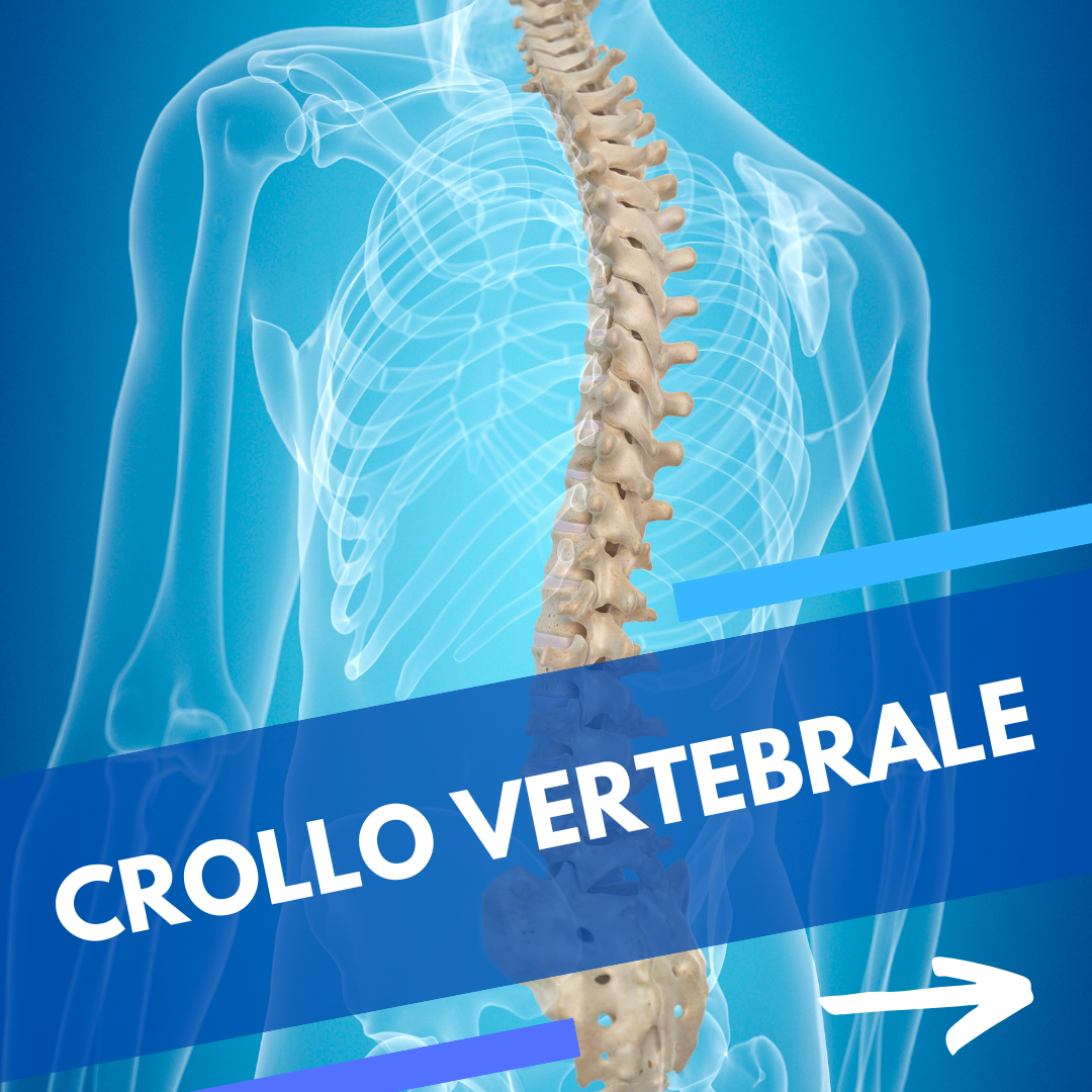Crollo vertebrale: Trattamenti efficaci, sintomi e cause