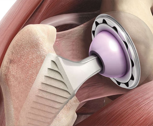 Protesi anca mini invasiva: vantaggi, riabilitazione e recupero